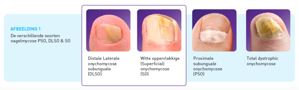 About Fungal Nail - Mycosan